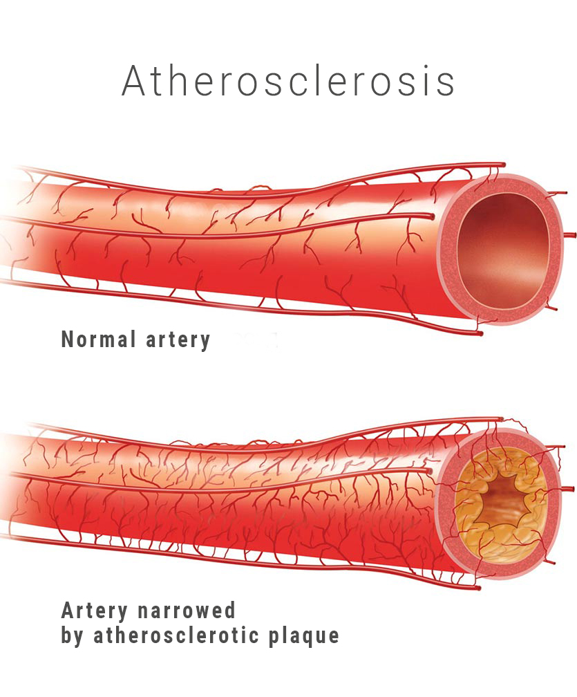 Файл:Atherosclerosis.jpg — CardioWiki